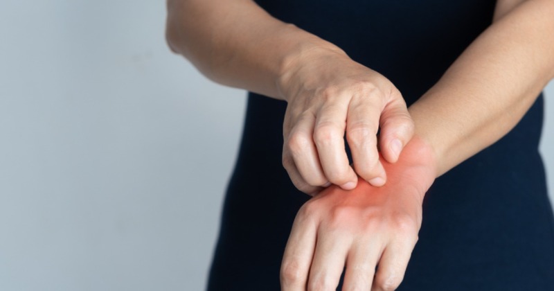 त्वचारोग तज्ज्ञाकडून समजून घ्या, खरूज म्हणजे काय? लक्षणे, कारणे आणि ...