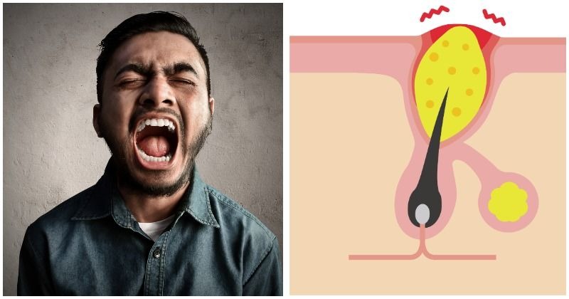 5 Ayurvedic Remedies For Boils, Causes & Symptoms (Baltod)